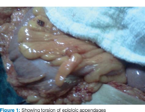 Figure 1 From Torsion Of Appendix Epiploicae As A Cause Of Abdominal