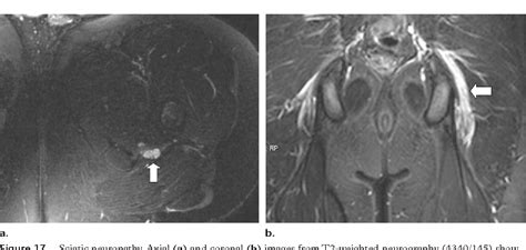 Figure 17 From Mr Imaging Of Entrapment Neuropathies Of The Lower