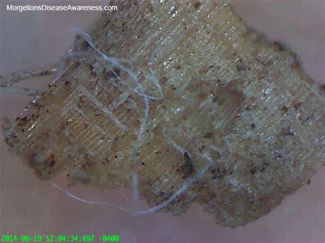 morgellons disease awareness morgellons disease physicians reference