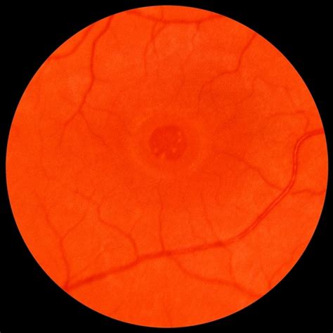 Macular Hole Retina Image Bank