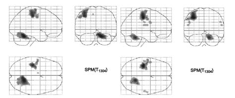 Comparison Of Cerebral Activation Patterns For Right Handed Performance