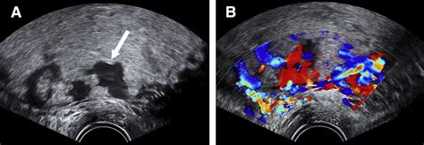 Placenta Accreta Spectrum Pathophysiology And Evidence Based Anatomy
