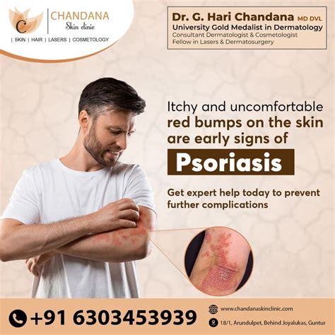 Vector Poster Causes Of Psoriasis Stock Illustration
