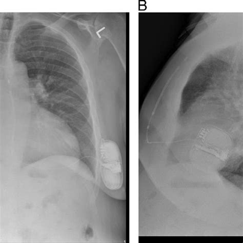 A Patients Posteroanterior Chest Radiograph B Patients Lateral