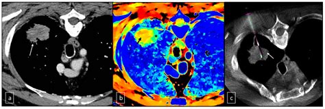 Jcm Free Full Text Dual Layer Spectral Ct As Innovative Imaging