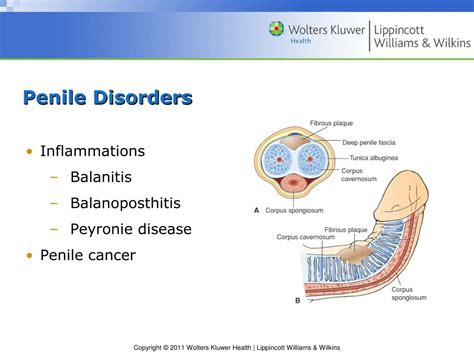 Ppt Chapter 39 Disorders Of The Male Genitourinary System Powerpoint