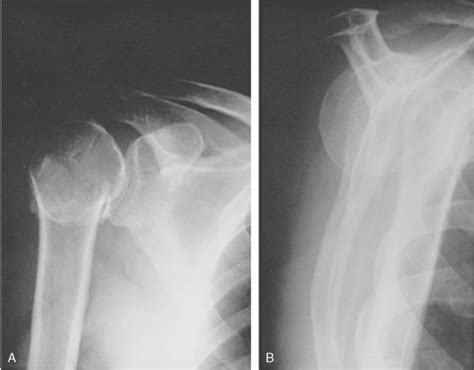 Proximal Humerus Surgical Neck Fracture