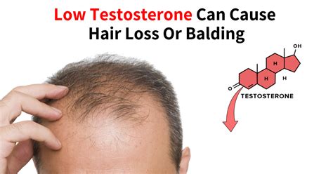 Low Testosterone Can Cause Hair Loss Or Balding Hair Loss Part 2 Dr