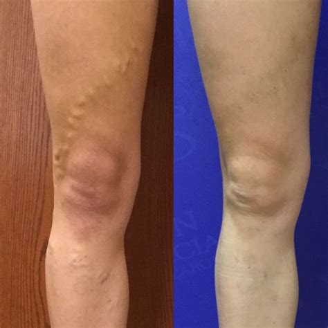 Today Is Transformation Tuesday Vein Specialists Of The Carolinas