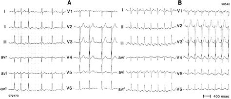 contemporary management of atrial flutter circulation