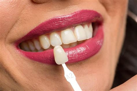 5 Benefits Of Dental Veneers Cosmetic Dental Services Atascocita Tx