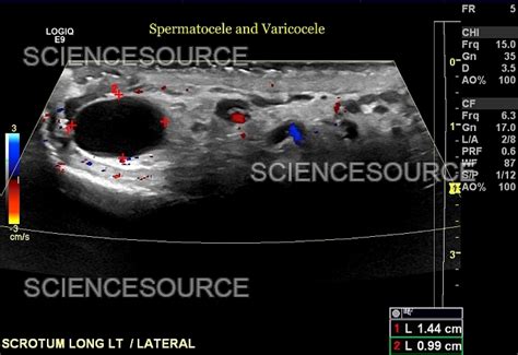 Varicocele Ultrasound Procedure