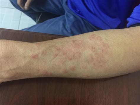 Bị Ngứa Da Do Giun Sán Dấu Hiệu Nhận Biết Và Thời Gian Điều Trị