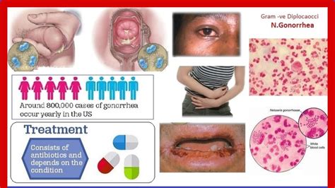 Gonorrhea Signs