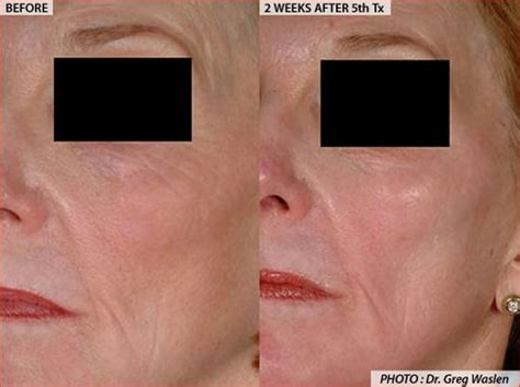 Laser Genesis Skin Rejuvenation Alamo Hills Advanced Aesthetics