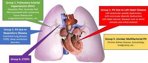 Simple Illustration Of Different Pulmonary Hypertension Groups