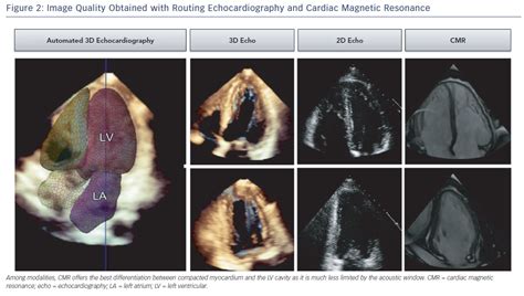 The Role Of Automated 3d Echocardiography For Left Ventricular Ejection