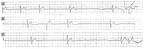 Medicina Free Full Text Electrocardiographic Patterns In Patients