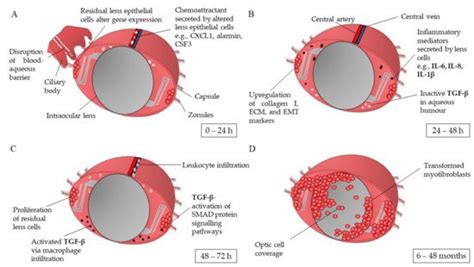 Posterior Capsule Opacification Encyclopedia Mdpi