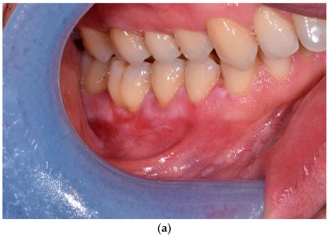 Treatment Of Reticular Oral Lichen Planus With Photodynamic Therapy A