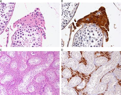 Insl3 Expression In Leydig Cell Hyperplasia And Leydig Cell
