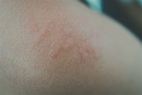 蕁麻疹の原因とは？症状や治療法について解説 ヒロオカクリニック