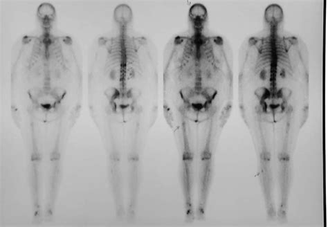 metastatic bone disease fact sheet westmead bci