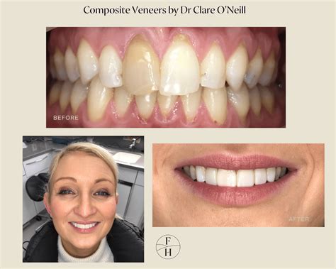 Composite Bonding Dental Veneers Finkle Hill Dental