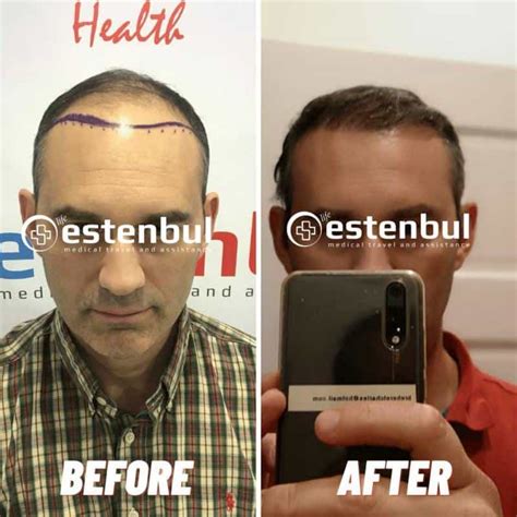 Hair Transplant Turkey Before After 2024 Estenbul Health