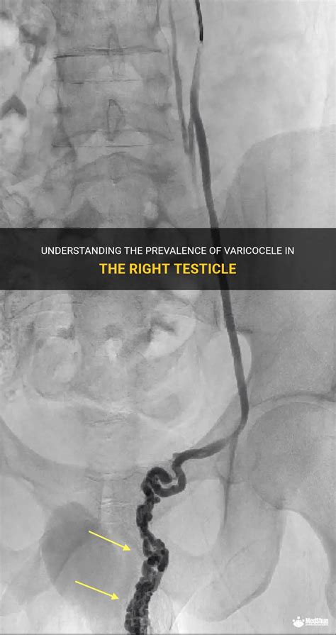 Understanding The Prevalence Of Varicocele In The Right Testicle Medshun