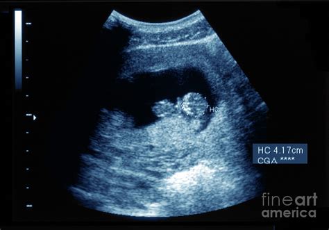 Intrauterine Pregnancy Photograph By Zephyr Science Photo Library Pixels