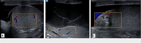 [pdf] Evaluation Of Scrotal Pathologies By Ultrasound And Color Doppler