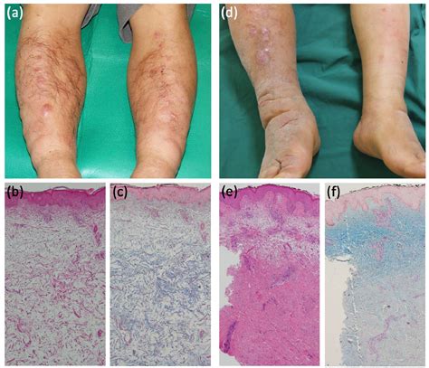 Figure 1 From Pretibial Myxedema Exhibiting Prominent Asymmetrical