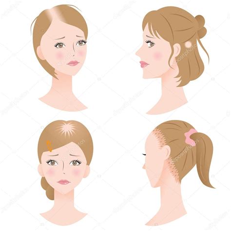 Female Hair Loss — Stock Vector © Mug5 124567146