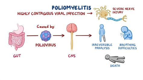 Polio Symptoms And Causes