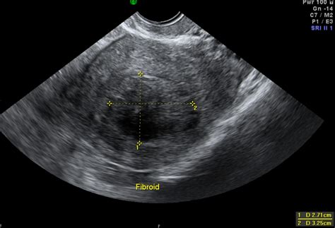 Transvaginal Ultrasound Fibroids