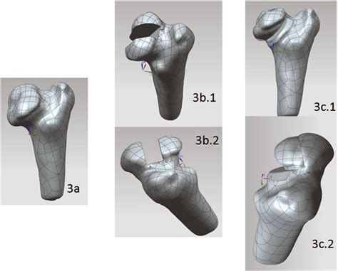 A Femoral Head Reduction Surgery Is Performed On The 3d Model Obtained