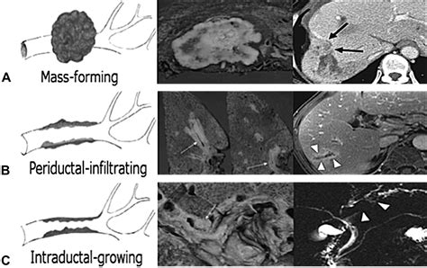 Intrahepatic Cholangiocarcinoma Management Options And Emerging