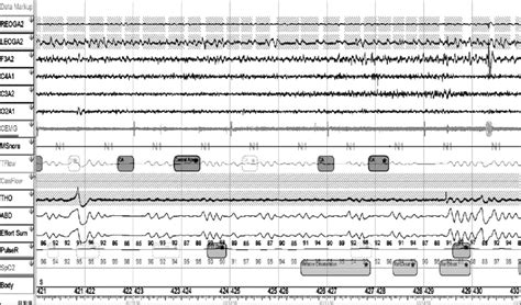 Polysomnography Five Minute Window With Epoch 421−430 Showing Central