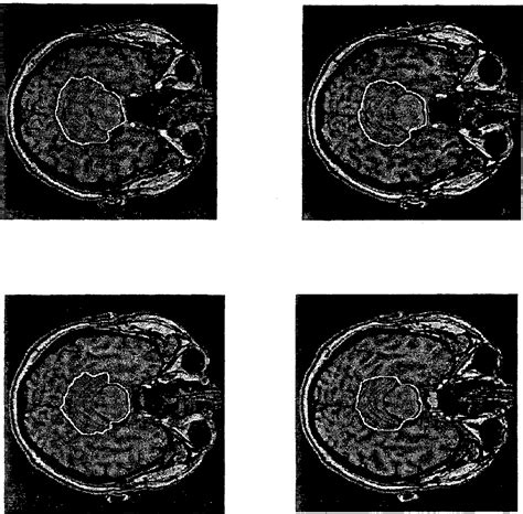 figure 1 from mri brain image segmentation using an am fm model