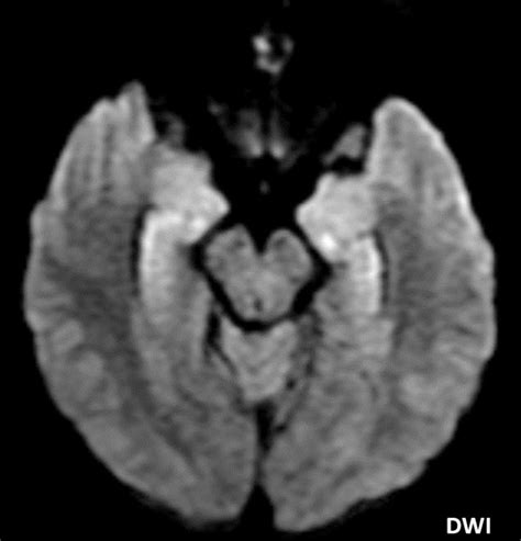 Classic Case American Journal Of Neuroradiology