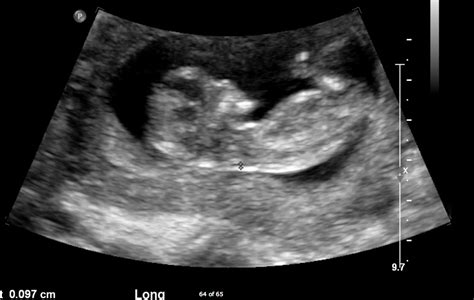 Ultrasound And Pregnancy The First Trimester Diagnostic Imaging