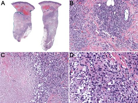 Multifocal Pleomorphic Dermal Sarcoma And The Role Of Inflammation And