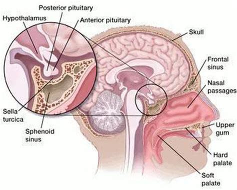 Causes Of Pituitary Adenoma Medizzy