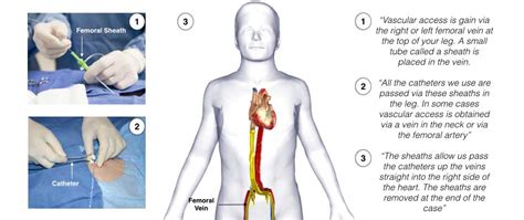 atrial flutter ablation melbourne heart rhythm