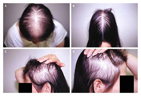 Hair Loss In Women Nejm