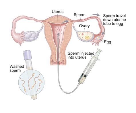 Intrauterine Insemination Iui What It Is And How It Works