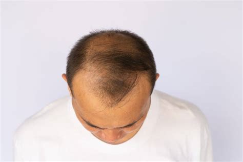 5 Treatments To Prevent And Treat Hair Loss In Singapore Tricholab
