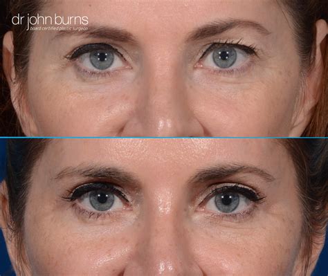 Upper Blepharoplasty Before After