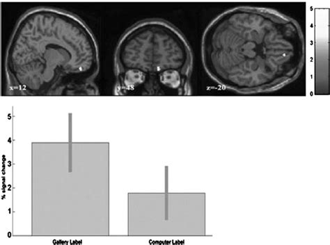 Upper Panel Activation In The Right Medial Orbitofrontal Cortex Ofc